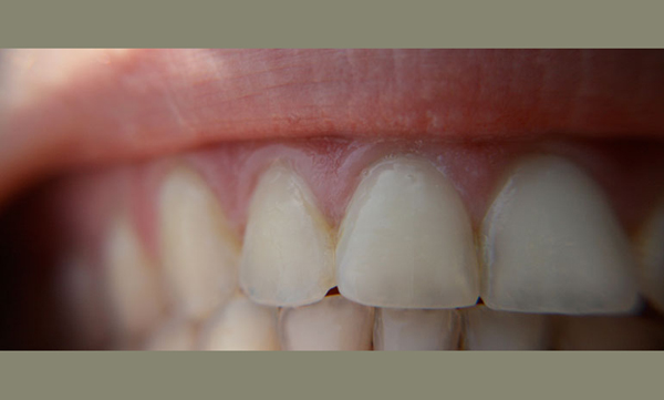 Fogorvos: nagy melegben könnyebben belobban a gyulladt fog – Budaörsi Infó